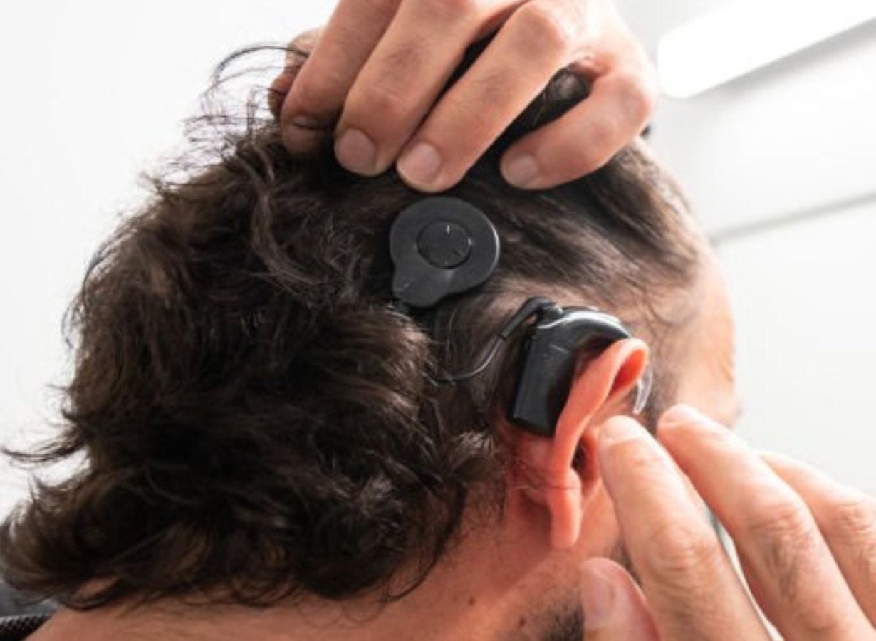 Vantagens e Desvantagens dos Implantes Cocleares | Clínica ORL